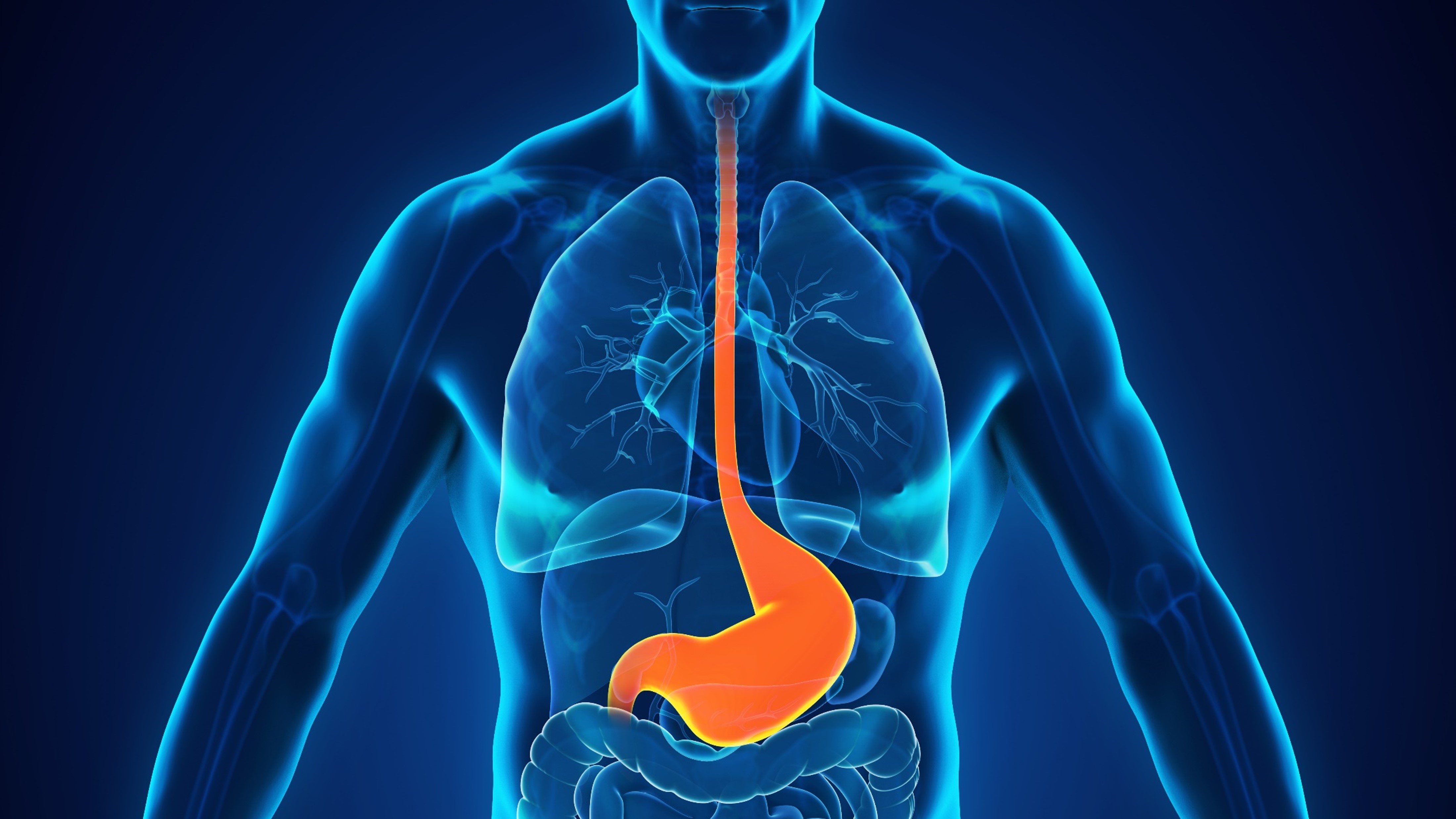 Adenocarcinoma avanzado gástrico o de la unión gastroesofágica ...